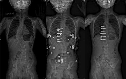 Chirurgie mini-invasive « vertebral body tethering » : le CHU Grenoble ...